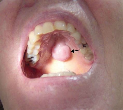 Torus Palatinus Causes Symptoms Diagnosis And Treatment