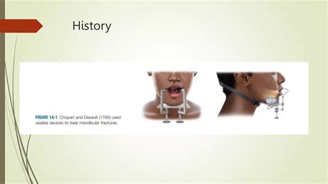 Mandibular Fracturepptx Mandibular Fracturepptx