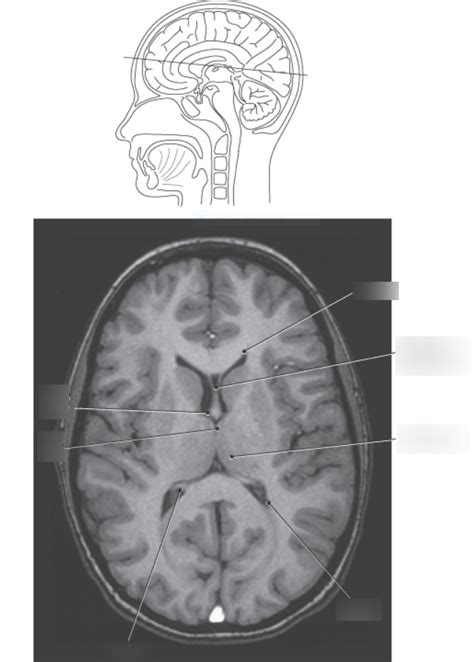 Mri Brain Anatomy Axial Diagram Quizlet 43 Off