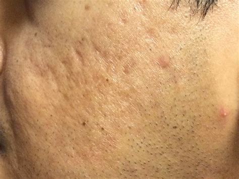 Transform Your Skin Microneedling Before And After Results