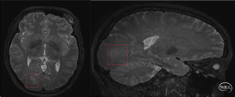 温医一院神经外科病例分享（20）：手术机器人辅助下利用立体定向脑电图seeg技术治疗难治性癫痫1例 脑医汇