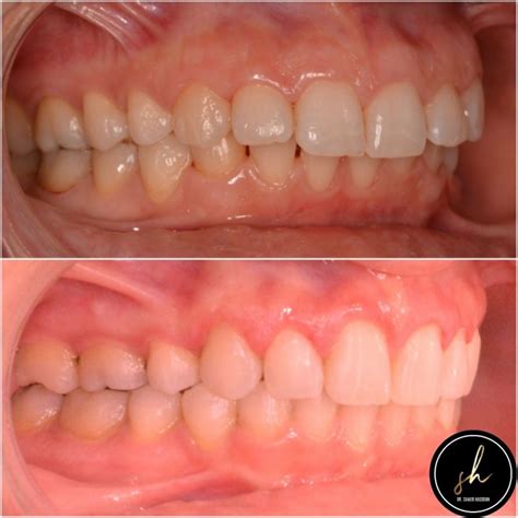 An Adult Class Ii Malocclusion With Maxillary Prominence Deep Anterior Over Bite Gummy Smile
