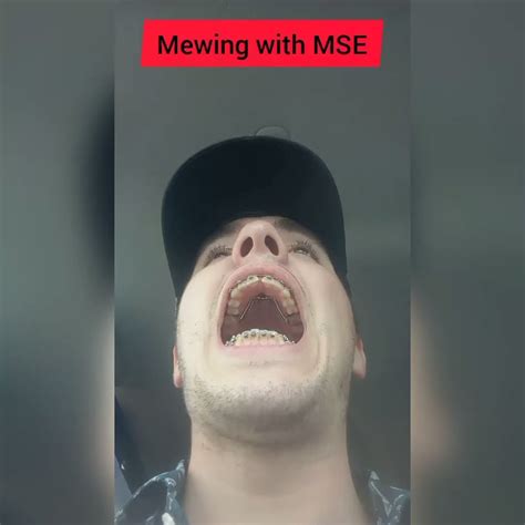 Mewing With Mse Rmewing