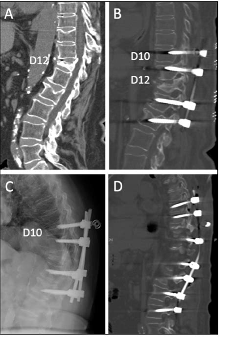 A Tc Sagital A Nivel Dorsolumbar Se Observa Fractura Por Compresión Download Scientific
