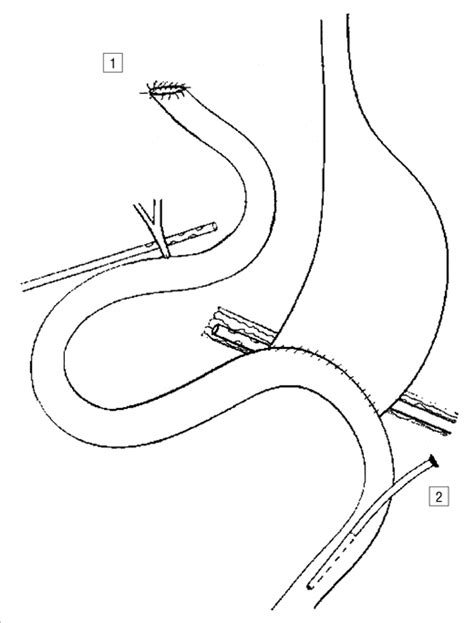 Completion Pancreatectomy for Postoperative Peritonitis After Pancreaticoduodenectomy ...