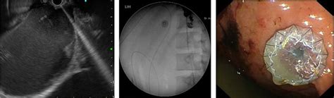 Endoscopic Ultrasound Guided Pseudocyst Drainage Using A Lumen Apposing