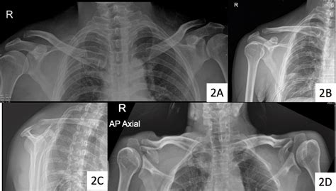 Ipsilateral Proximal And Distal Clavicle Fractures Combined With