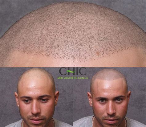 Scalp Micropigmentation Chic Med Aesthetic Clinics