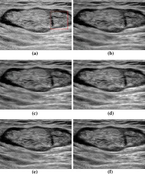 The Despeckled Results On A Real Ultrasound Lymph Node Image A The Download Scientific Diagram