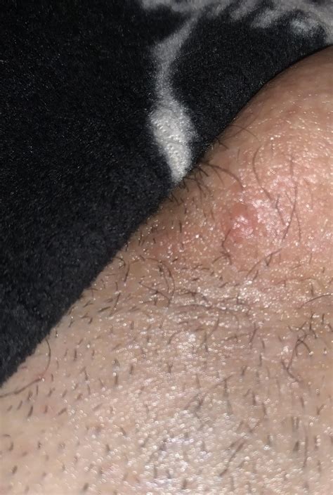 Post Scabies R Scabies