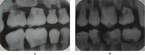 Proximal Caries Detection Accuracy Using Intraoral Bitewing Radiography