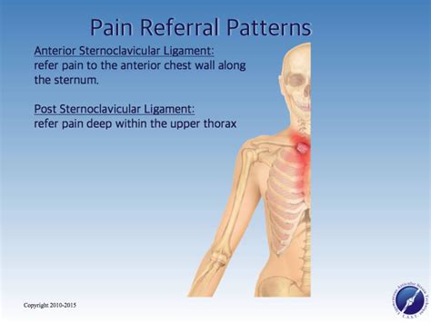 Sternoclavicular Joint Sprain