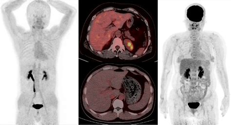 FDG And FAPI Images Of Two Healthy People Respectively The FAPI Download Scientific Diagram