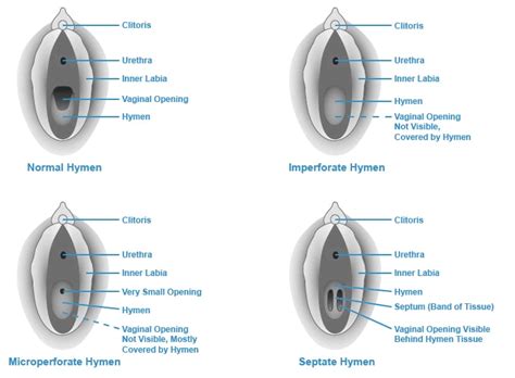 Trying to lose virginity hurts too badly, conflicting info about hymens ...