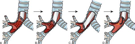 Multimodality Approach To Malignant Airway Obstruction Thoracic Key
