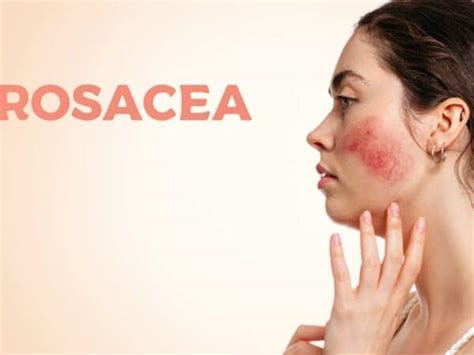 The 4 Types Of Rosacea And How To Treat Them