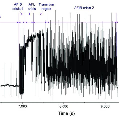 Pulse Time Variation 1 R R Interval During Fibrillation Crises