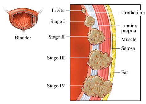 Bladder Cancer Explained Important Insights You Need To Know Oruba