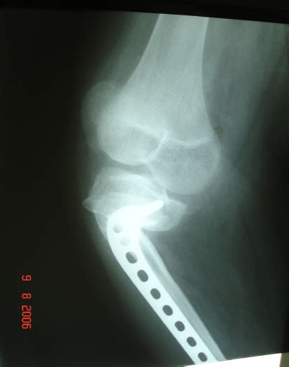 Lateral View With Marked Procurvatum Deformity Download Scientific Diagram