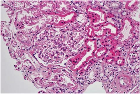 Podocyte Infolding Glomerulopathy Light Microscopic Examination Of