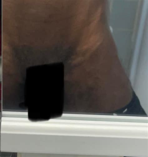 I Have These Lymph Nodes Around My Groin Area Should I Be Concerned