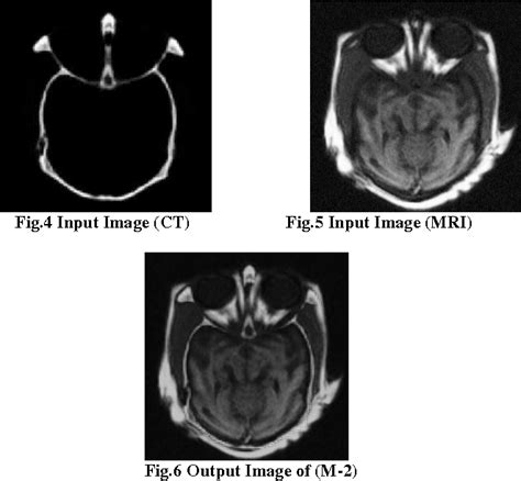 Figure 4 From Comparison Of Medical Image Fusion Algorithm For