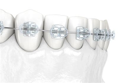 치아와 클리어 중괄호 의학적으로 정확한 치과 3d 일러스트레이션 버팀대에 대한 스톡 사진 및 기타 이미지 버팀대 이빨 도예 Istock