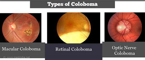 Coloboma Causes Symptoms Diagnosis Treatment And Prevention