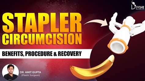 Stapler Circumcision - Benefits, Procedure & Recovery | Foreskin Retraction | Dr. Amit Gupta ...