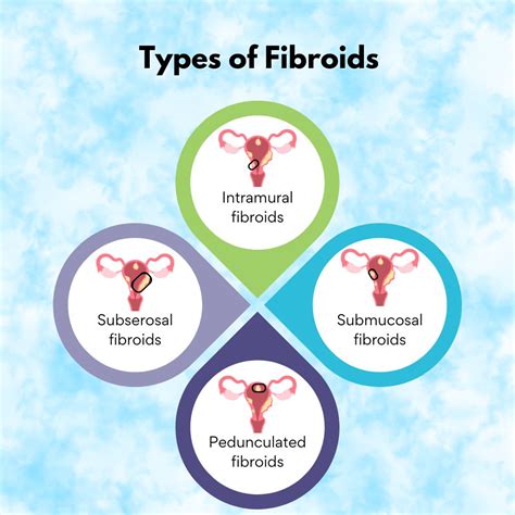 Gynesonics Inc On Linkedin Fibroidtypes Womenshealth Fibroidawareness