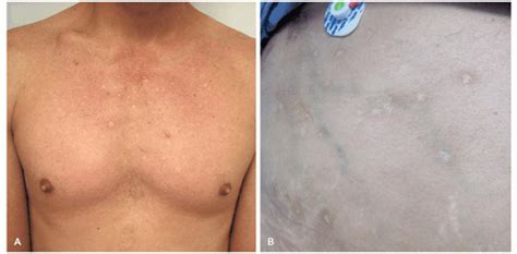 Hypopigmentation Scar