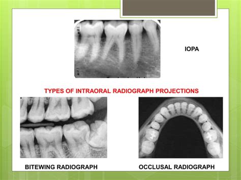 Paralleling And Bisecting Radiographic Techniques Pptx Dental