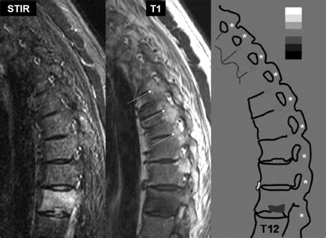 Mri Lesions Of The Spine In Patients With Axial Spondyloarthritis An