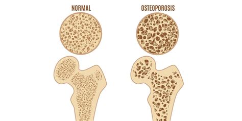 One Small Molecule May Transform Osteoporosis Treatment Drug