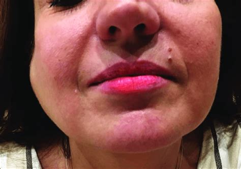 Preauricular Swelling Of The Right Side Of The Patients Face