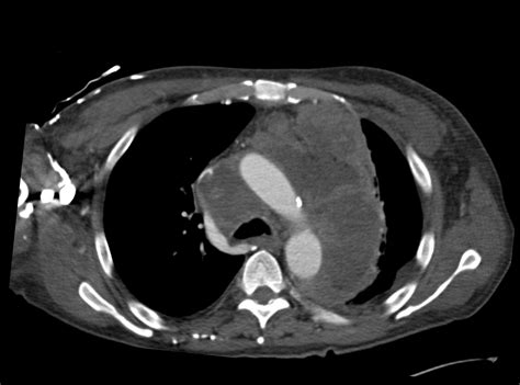 CT Case LITFL CT Scan Interpretation
