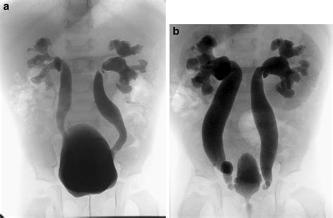 Bilateral Grade Iv Reflux In A 14 Month Old Girl A At The End Of