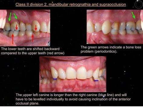 Class Ii Div 2 Malocclusion Pptx
