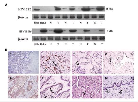 Figure 1 From Human Papillomavirus 16 18 E6 Oncoprotein Is Expressed In Lung Cancer And Related