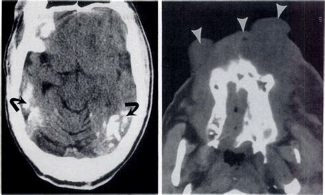 Persistent Trigeminal Artery Download Scientific Diagram