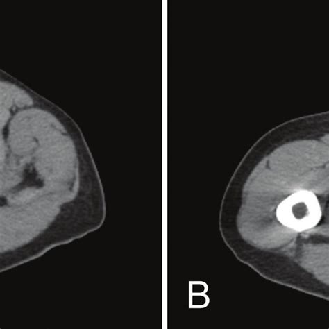 Axial Ct Of The Pelvis A Showing Densification Of Adipose Tissue And
