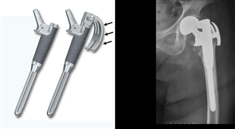 A Novel Bipolar Hip Prosthesis Bhp Implant Characterized By An