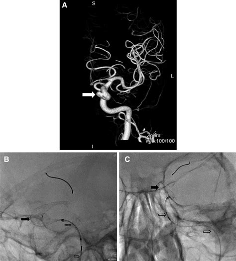 Versatile Use Of Catheter Systems For Deployment Of The Pipeline Embolization Device A