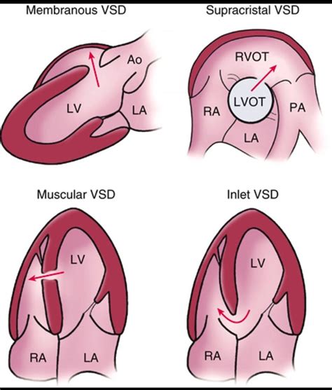 The Heart 🔴ventricular Septal Defect Vsd Types Imaging And Clinical Significance⤵️ 🔹vsds