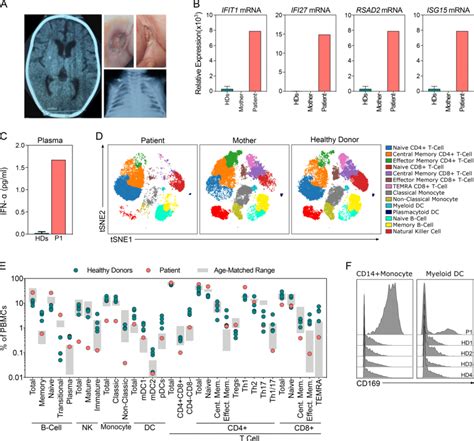 Peripheral Blood Signature Indicates Autosomal Recessive Type I