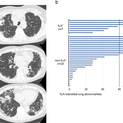 A A Patient With Nonfibrotic Interstitial Lung Abnormalities Leading