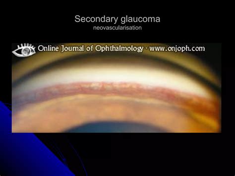 Secondary Glaucoma Ppt