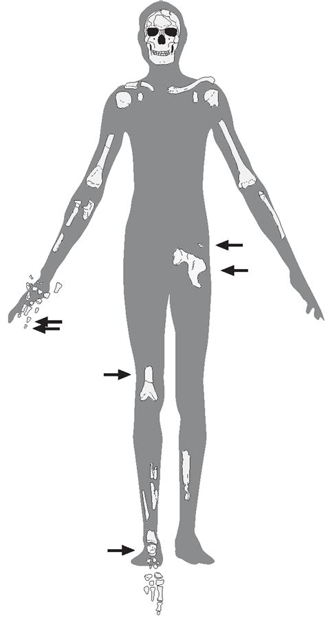 Olecranon Process Semantic Scholar