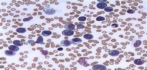 Differentiation Landscape Of Acute Myeloid Leukaemia Charted With New Tool