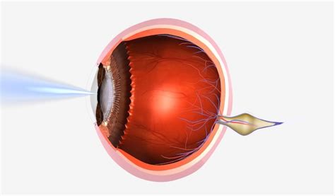 Premium Photo Presbyopia Is A Degenerative Eye Condition